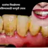 Home Remedies For Teeth Whitening How To Remove Yellow Plaque Tartar ...