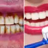 Yellow Teeth Whiten Remove Tartar Plaque : पिवळे दात स्वच्छ पांढरेशुभ्र ...
