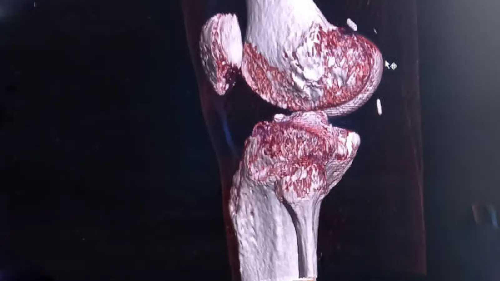 bone cancer symptoms in marathi