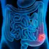 Fruits for prevent colon cancer; आतड्याचा कॅन्सर होऊ नये म्हणून फळे ...