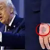 US President Donald Trump Hand Blue Bruise Heavy Aspirin Dose; हातावर ...