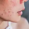 7 Early Signs and Symptoms on Face of Blood Cancer; चेहऱ्यावर दिसतात ...