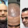 Hair Care After Hair Transplant,CID के दया और राजपाल यादव ने कराया हेयर ...