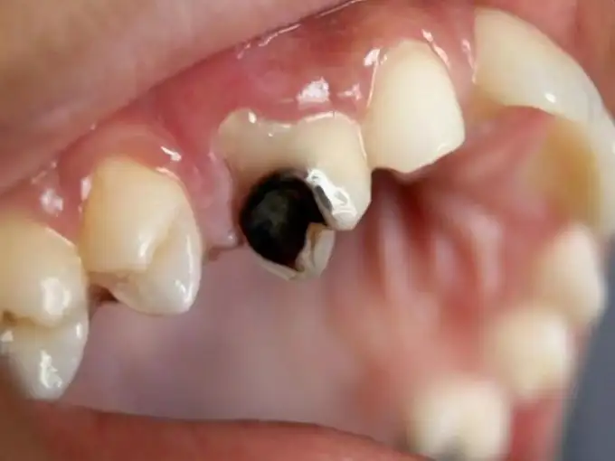 दांत के कीड़े के नुकसान