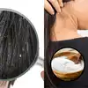 What Causes Dandruff During Summer,खोपड़ी से डैंड्रफ को खुरच देगा ...