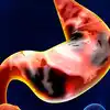 How To Detect Cancer Without Symptom,ना दर्द हुआ, न वजन घटा, खतरनाक ...
