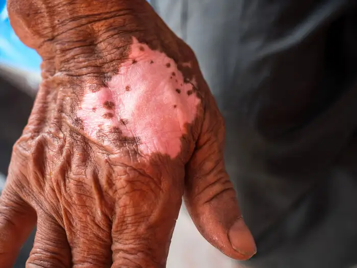 Kushtarog Symptoms,Kushtarog: कुष्ठ रोग के लक्षण और इलाज के बारे में वो ...