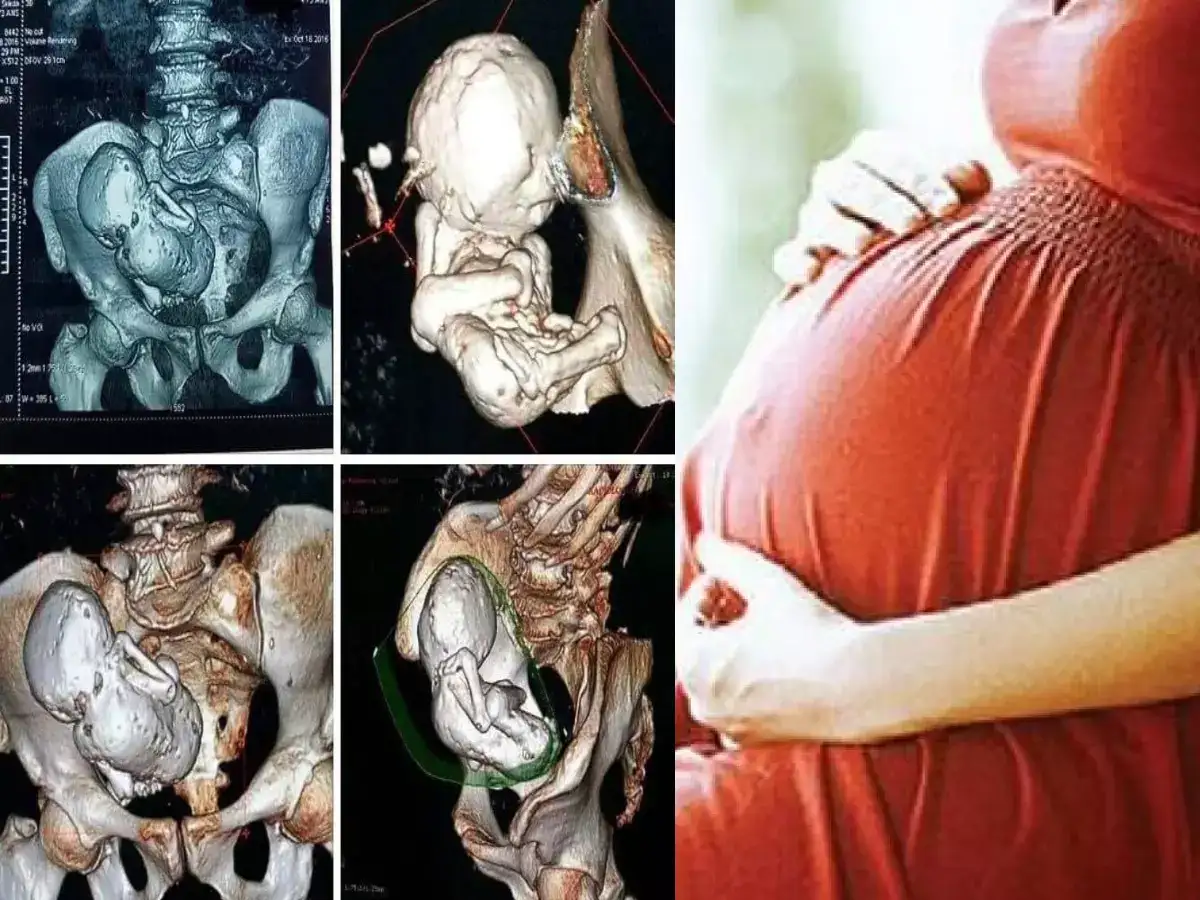 Stone Baby,Lithopedion : 35 ஆண்டுகளாக கர்ப்பமாக இருந்த 73 வயது பாட்டி ...