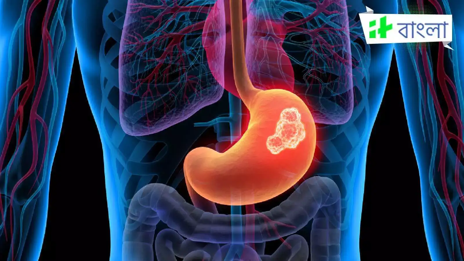 Countries With High Stomach Cancer,এই ৫ দেশেই স্টমাক ক্যানসারে ...
