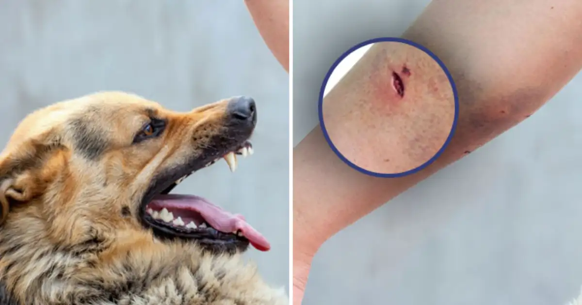 What To Do After A Dog Licks A Child?,Child Dies from Rabies: कुत्ते के ...