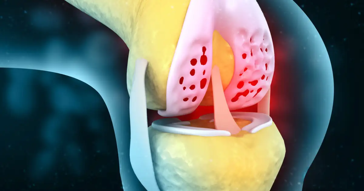 Cracking Sound in Knee: मेरे घुटनों से कट-कट की आवाज आती है, दर्द नहीं ...