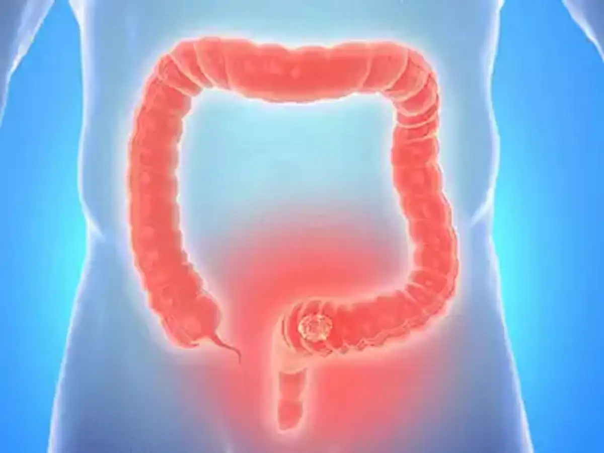 Kudal Cancer Arikurikal,குடல்ல புற்றுநோய் இருந்தா எப்படி ...