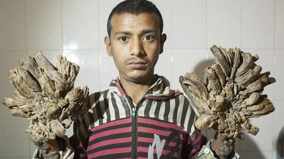 Tree Man,Bangladesh Tree Man: உலகில் முதல் ஆளுக்கு வந்த "மரமனிதன்" நோய் ...