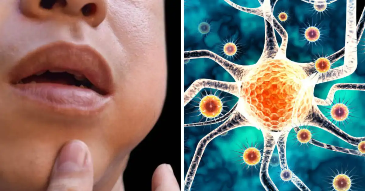 Mumps Disease Symptoms : केरळमध्ये मंप्सचा प्रकोप, काय आहे हा आजार आणि ...