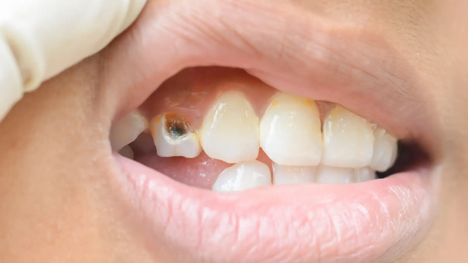 Cavities, Infection and Fertility: Why Dental Health Matters