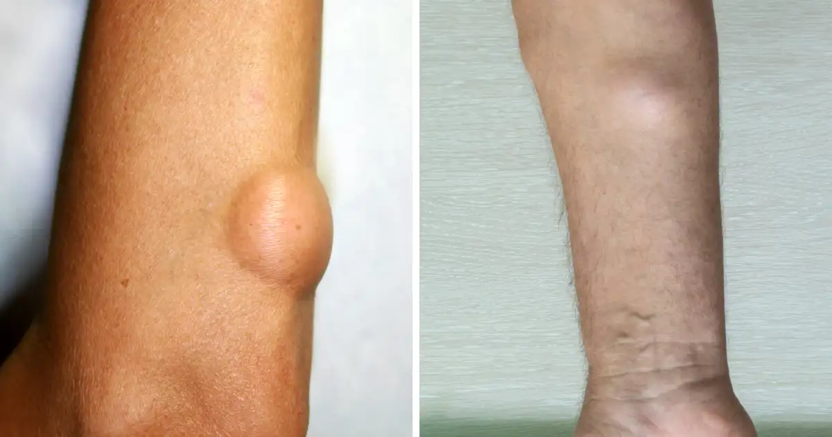 Hath Me Ganth Hona Ka Matlab,Lipomas Causes: क्या हाथ-पैर में मौजूद ...