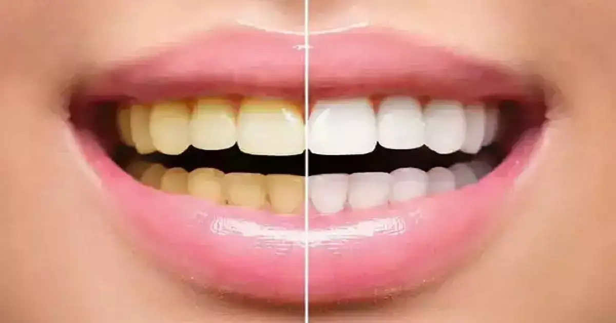 How To Clean Yellow Teeth,yellow teeth : மஞ்சள் பற்களை வெள்ளையாக்கும் ...