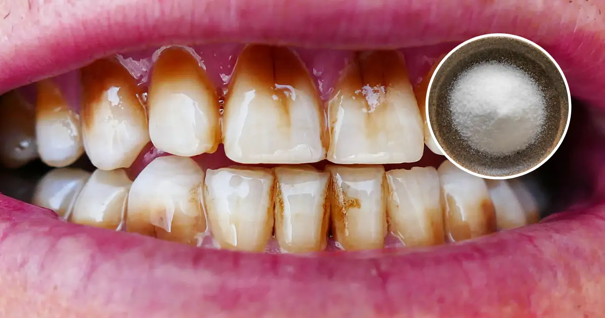 How To Remove Yellow Stains From Teeth,How To Clean Teeth: पीले दांत ...