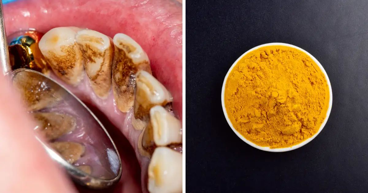 How To Treat Pyria Naturally,Best Pyorrhea Toothpaste: डॉक्टर रोबिन ने ...