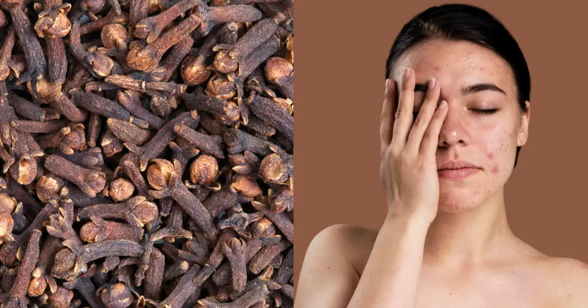 How To Use Cloves For Glowing Skin,फुंसियों ने छीन लिया चेहरे का निखार ...