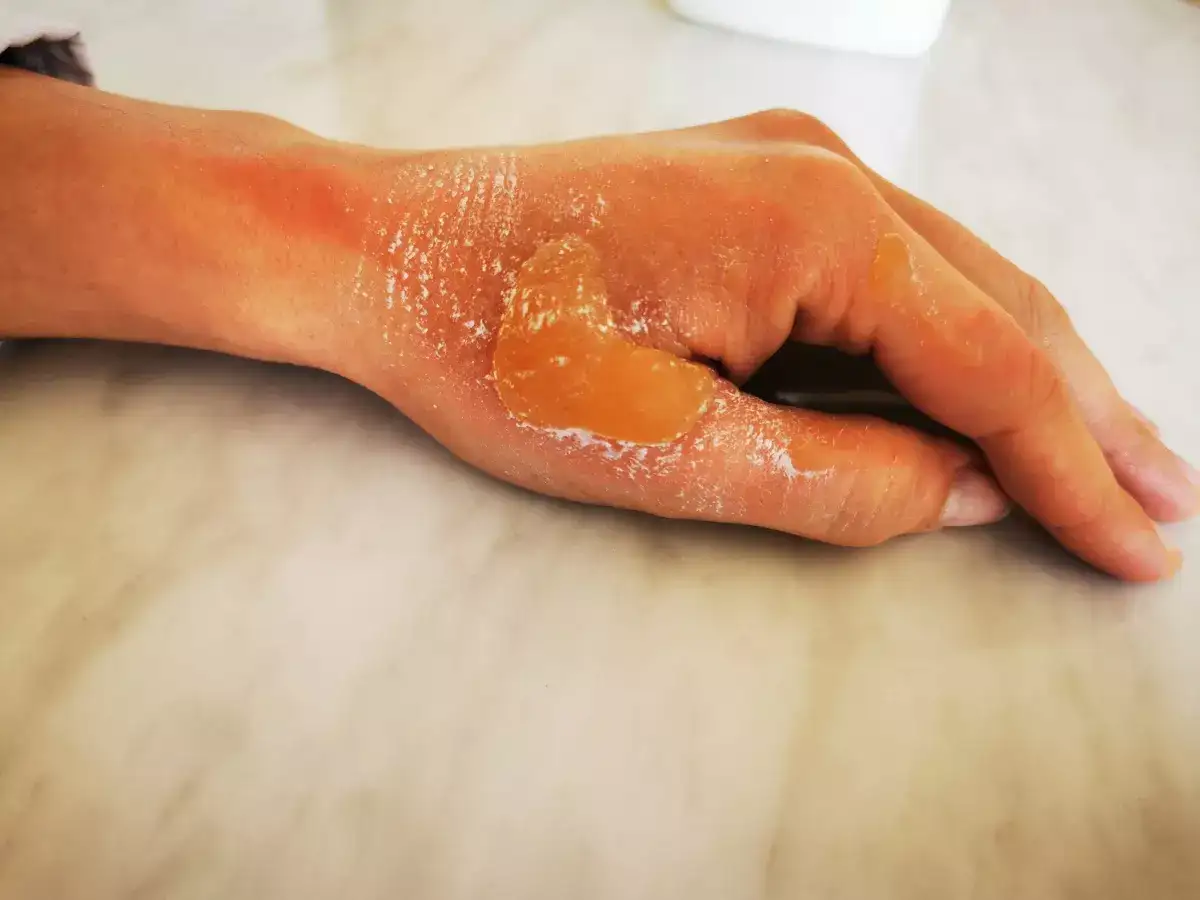 Quick Tips for Treating Burns - Burn Injuries: ఈ టిప్స్‌ ఫాలో అయితే ...