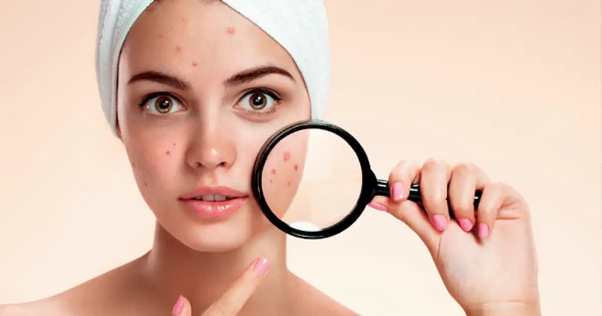 Skin Care,acne on face : முகத்தின் ஒரு பக்கத்தில் மட்டும் பரு அதிகமாக ...