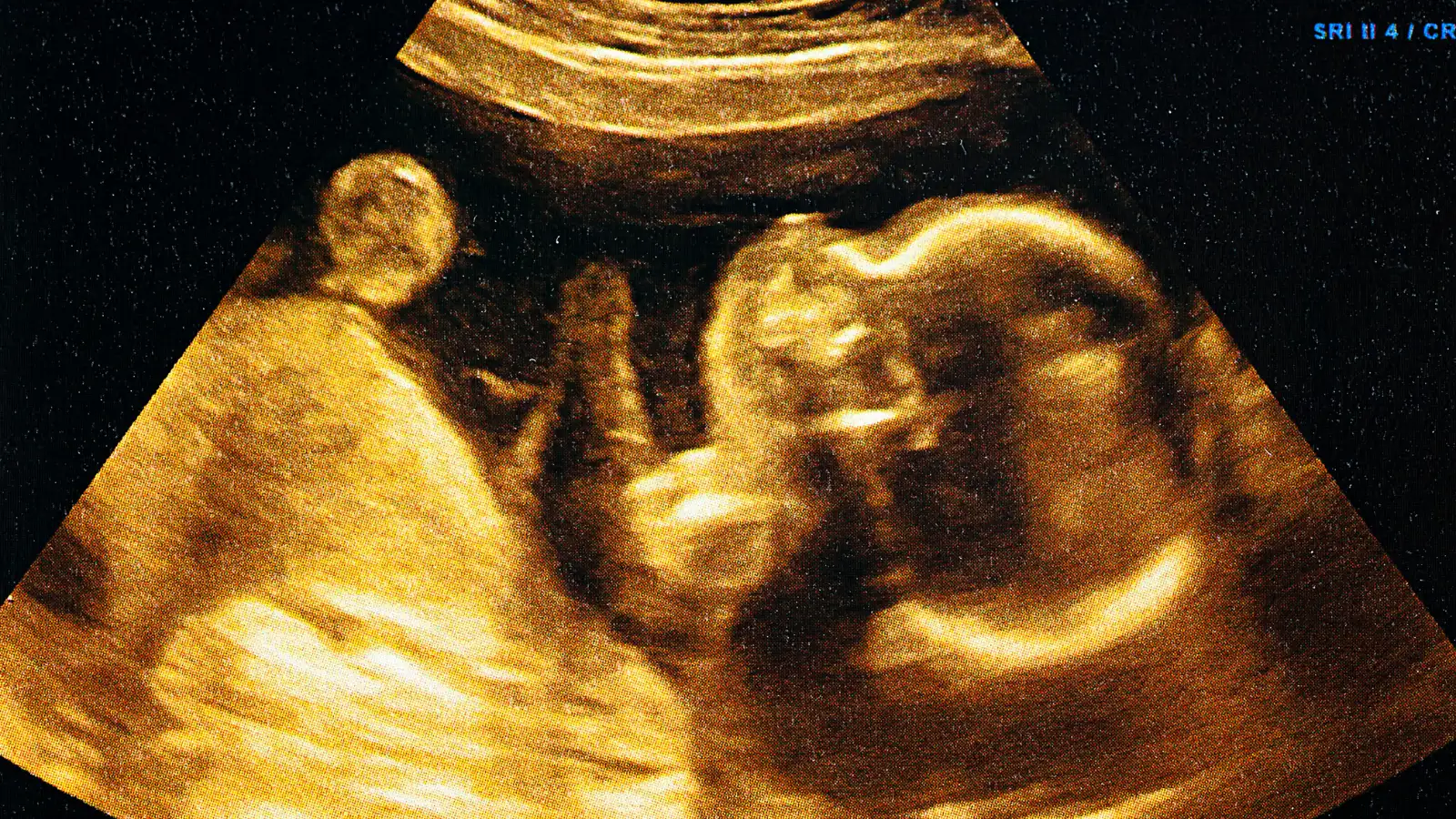 Foetal Movement Explained: A Guide to Monitoring Baby’s Activity and ...