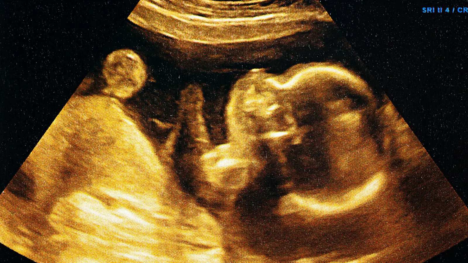 When and How Baby’s Eyelashes and Eyebrows Begin to Form