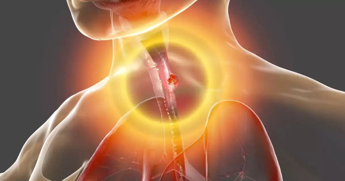 Food Pipe Cancer Symptoms,मरीज के Food pipe से निकला 6.5cm ट्यूमर ...