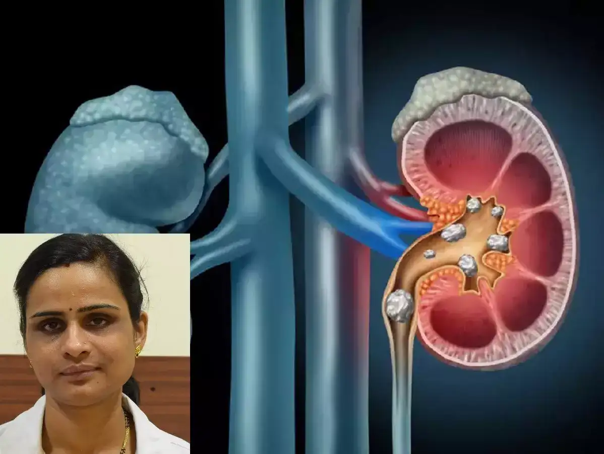 How To Use Keelanelli Powder,keelanelli : சிறுநீரக கல், பித்தப்பை கல் ...