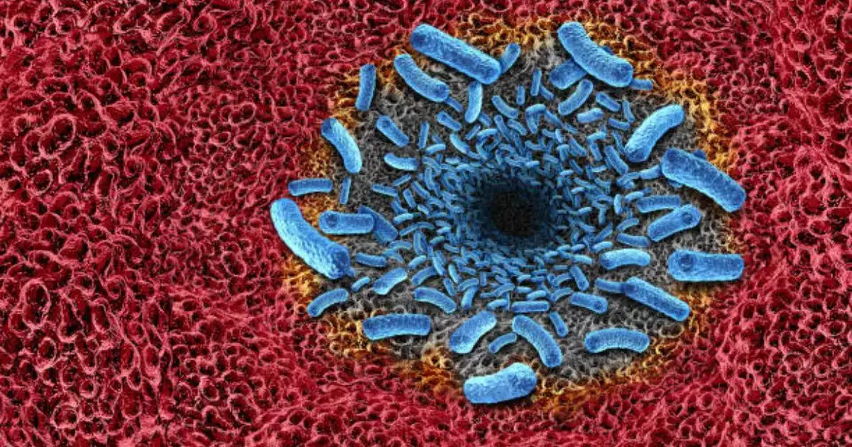 Flash Eating Bacteria Can Cause Fatal Bacterial Infection, Know About ...