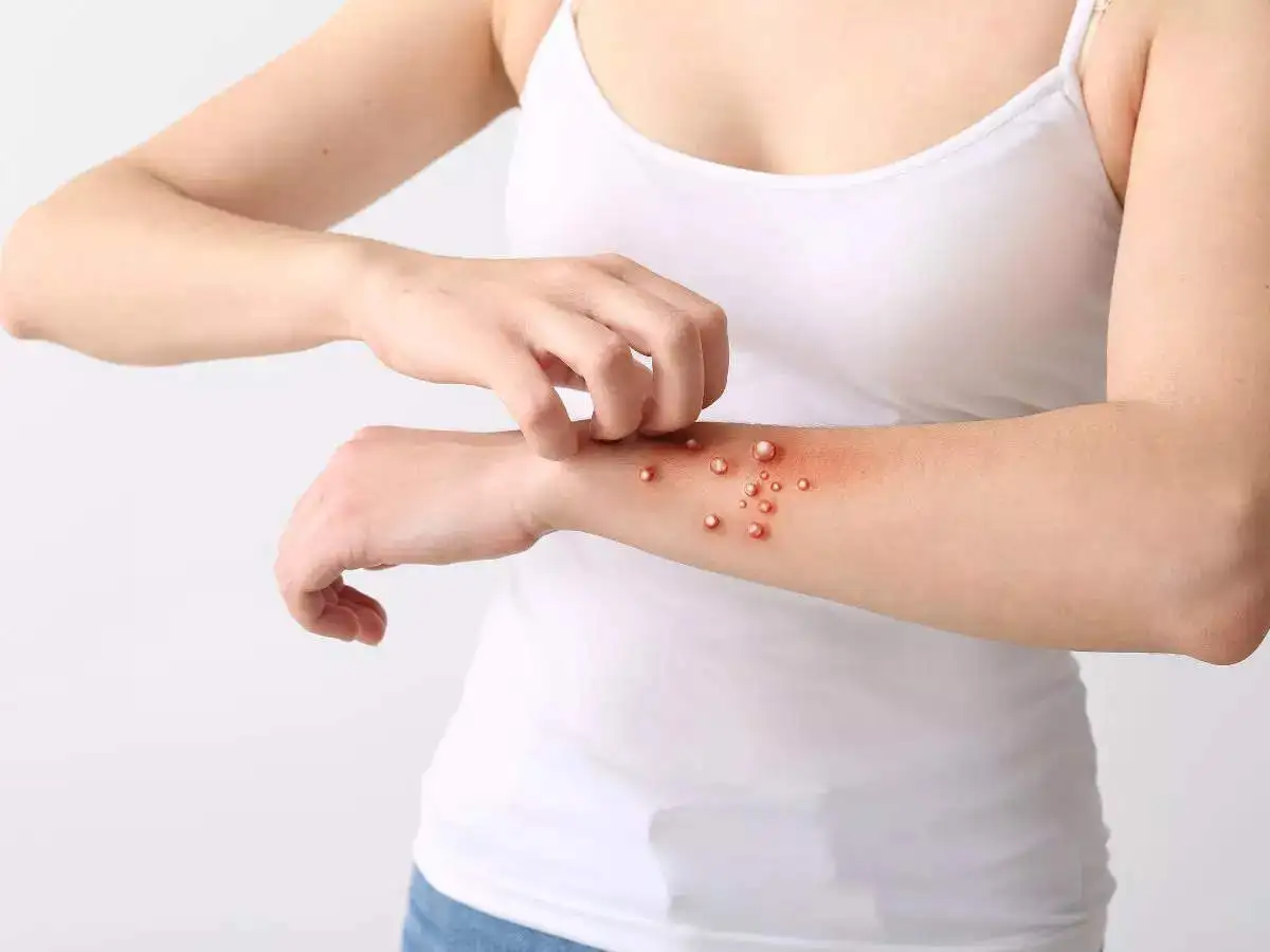 Skin Diseases During Rainy Season : மழைக்காலத்தில் ஏற்படும் மோசமான ...