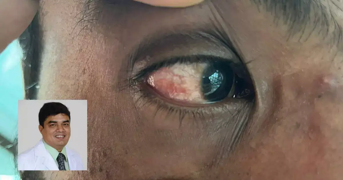 Madras Eye Symptoms,“மெட்ராஸ் ஐ” வந்தா என்ன பண்ணனும்? அறிகுறிகள் ...