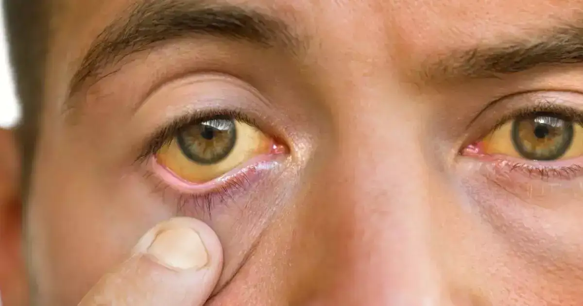 Jaundice in Malappuram: മലപ്പുറത്ത് ആശങ്കയായി മഞ്ഞപ്പിത്തം; 6000ത്തോളം ...