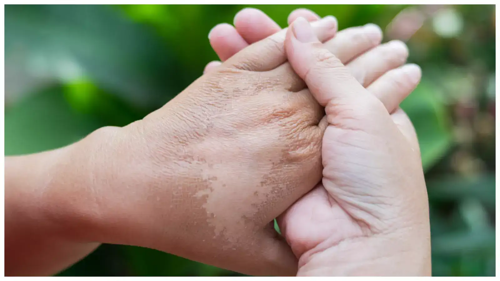 Honey For Burns,వంట చేసేటప్పుడు చేతులు కాలాయా.. వీటిని రాయండి ...