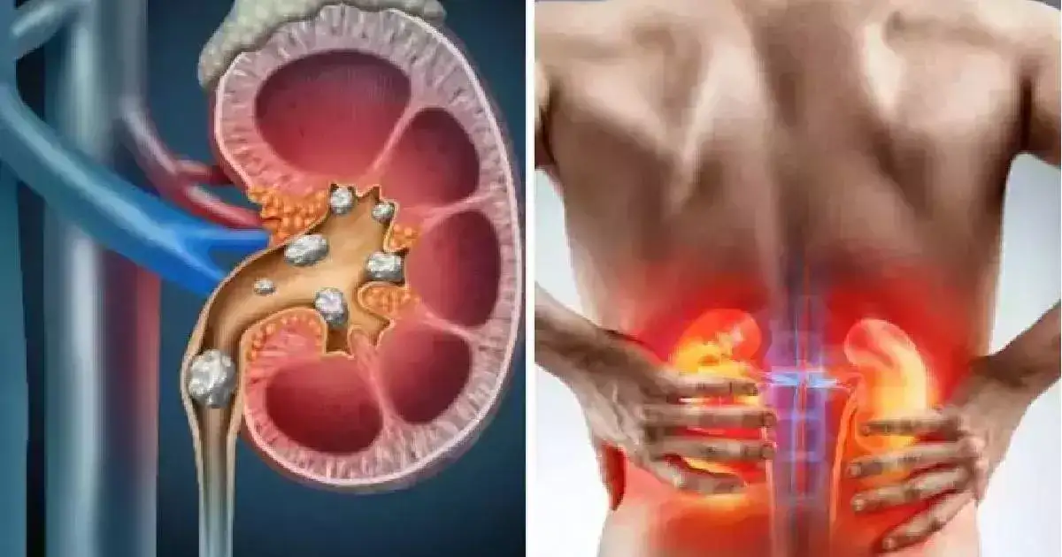 Home Remedies For Dissolve Kidney Stones or Mutkhada Naturally; Marathi ...