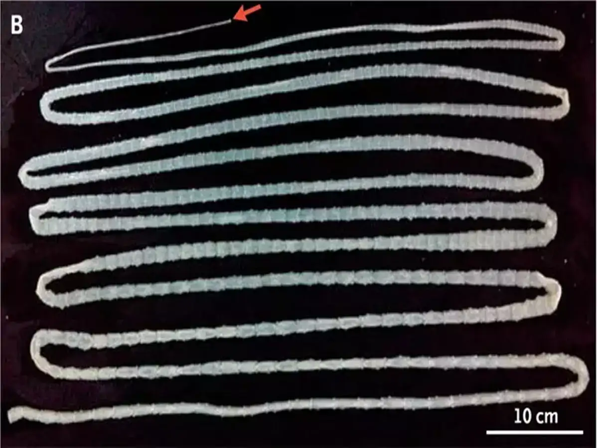 Are Tapeworms Harmful,कच्चा मांस खाने का शौकीन था चीनी शख्स, पेट से ...