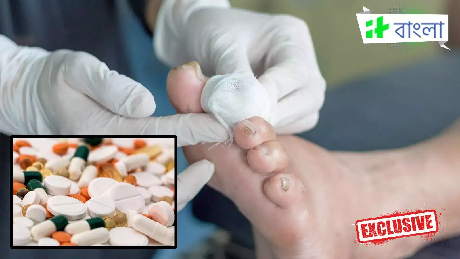 Antimicrobial Resistance In Diabetic Foot,যথেচ্ছ অ্যান্টিবায়োটিক ...