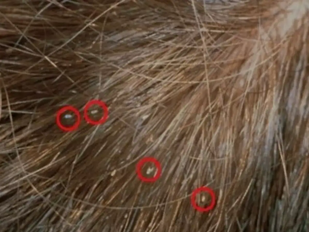 Head Lice,പേന്‍ ഒരു ദിവസം എത്രമുട്ട ഇടും എന്നറിയാമോ? - interesting ...
