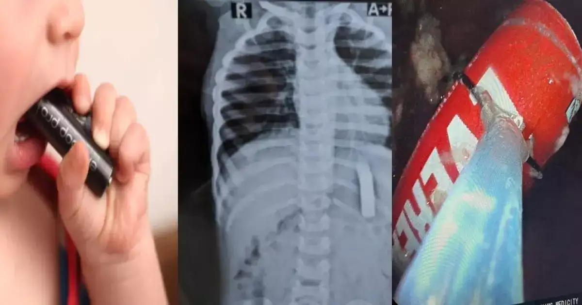 Kids Swallowed Battery,चिमुकल्यानं खेळता खेळता रिमोटचा सेल गिळला ...