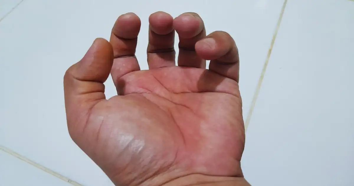 Dupuytren's Disease: Lump In Hands Is Not Just Cancer, This Disease ...