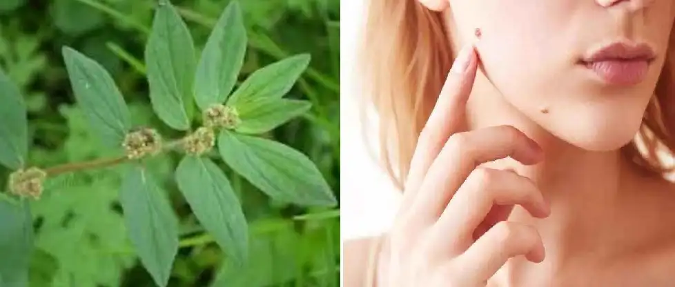 Maruvai Neekuvathu Yeppadi,முகம், கழுத்துப் பகுதியில் மரு இருக்கா, இந்த ...