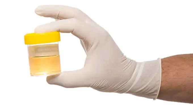 Kidney Failure 5 Signs And Symptoms In Urine; लघवीत दिसणारी ५ किडनी ...