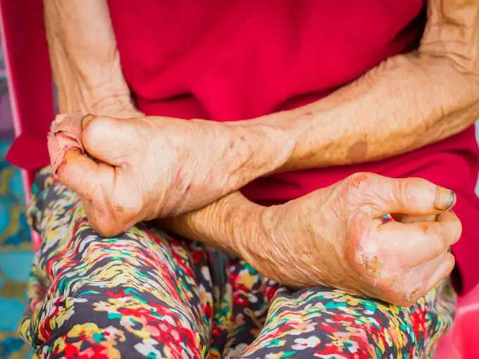 Kushtarog Symptoms,Kushtarog: कुष्ठ रोग के लक्षण और इलाज के बारे में वो ...