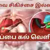 how to use ayurveda remedies to remove gallbladder stones in tamil