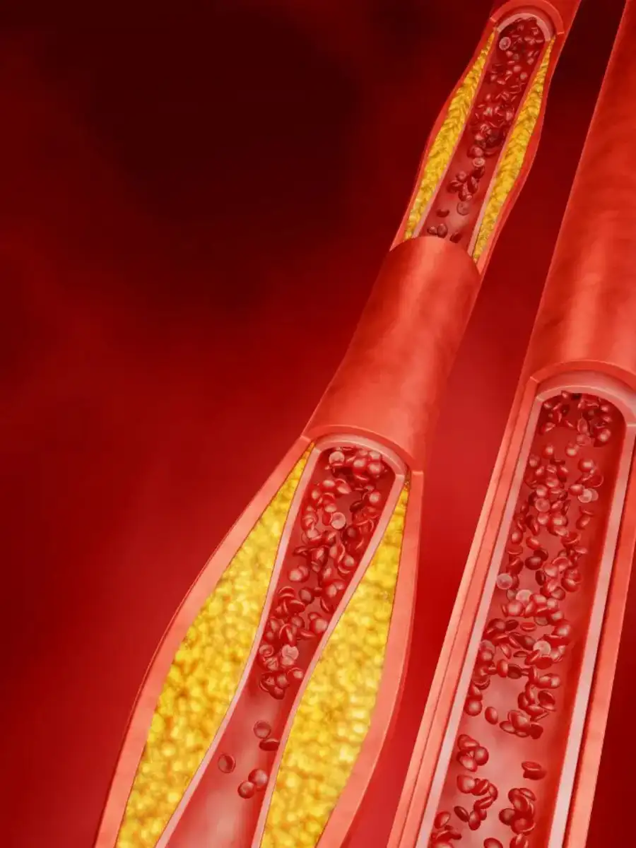 కొలెస్ట్రాల్‌ను వేగంగా కరిగించే చిట్కాలు | TeluguSamayam