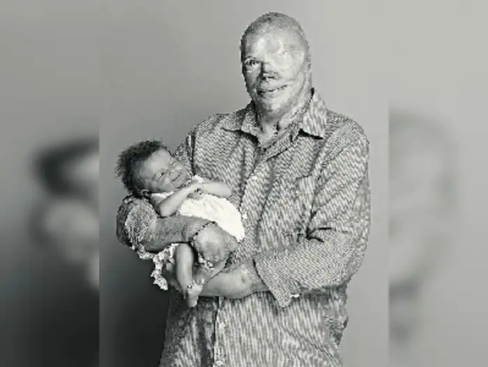 এই সময় ডিজিটাল ডেস্ক: বাঁচার আশা ছিল না তাঁর। আগুনে ঝলসে গিয়েছিল গোটা ...