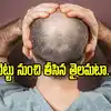 Fake Hair Growth Scam In Hyderabad,HYD Baldness Fraud: రూ.1300లకే ...