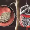 Intestinal Worms : பேதிக்கு கொடுக்காமலே குடலில் உள்ள புழுக்களை ...