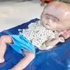 Dandy Walker Syndrome: பிரமாண்டமான மூளை, பெரிய தலையுடன் பிறந்த குழந்தை...